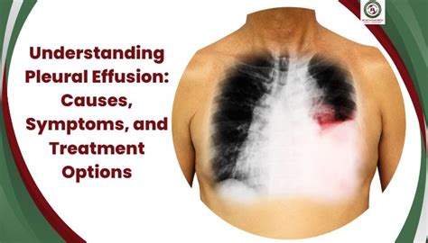 Understanding Pleural Effusion Causes Symptoms And Treatment Options