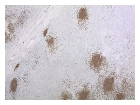 A The Dissected Neck Lymph Nodes Were Conglomerated B Normal Download Scientific Diagram