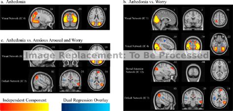 Resting State Network Hyperconnectivity And Expansion Associated With Download Scientific
