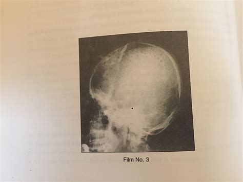 Xrays Of Hyperparathyroidism