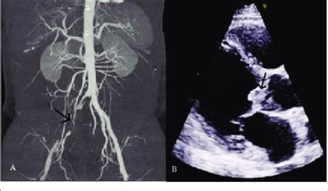 A Computed Tomography Angiogram Showing Complete Non Opacification Of Download Scientific