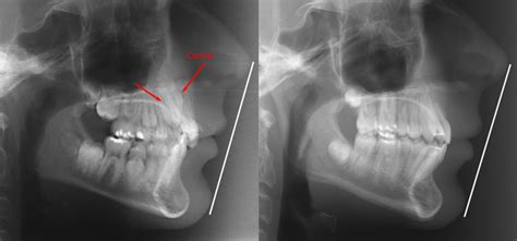 Classe Ii Division 2 Dr Sylvain Chamberland Orthodontiste