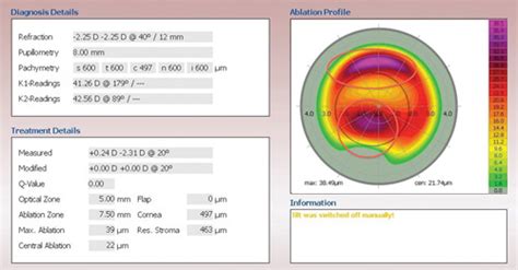 Topography Guided Ablation Pros And Cons