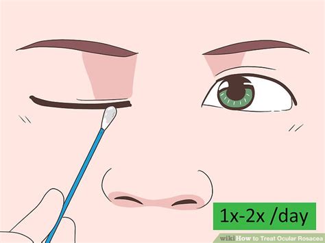 How To Treat Ocular Rosacea Steps With Pictures WikiHow