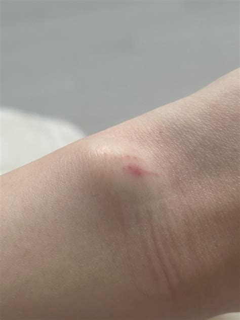 긁힌 상처 주위 동그랗게 빨간 이유가 뭔가요 ㅣ 궁금할 땐 아하