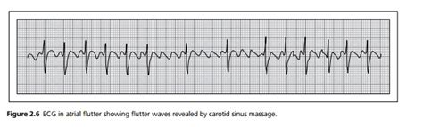 Atrial Flutter 2 1 Atrial Flutter With 1 1 Conduction Then 2 1