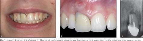 Figure 1 From Long Term Follow Up Of An Esthetically Demanding Case