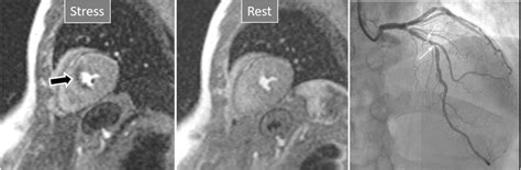 Induced Perfusion Defect Subendocardial Perfusion Defect At The Download Scientific Diagram