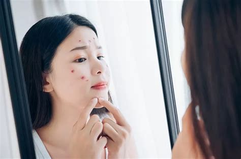 Cara Mudah Hilangkan Bekas Jerawat Membandel