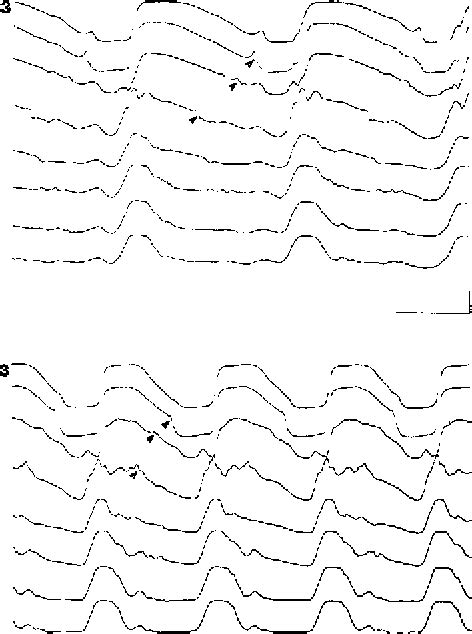 Figure 6 From Endocardial Happing Of Ventric Heart Ii Evidence For