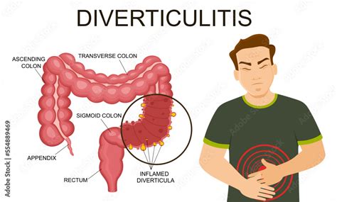 Diverticulitis And Diverticulosis Vector Illustration Medical Structure And Location