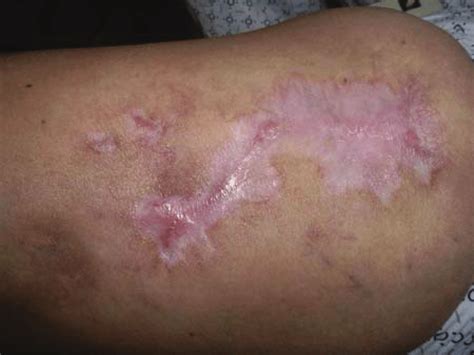 Mild Pyoderma Gangrenosum