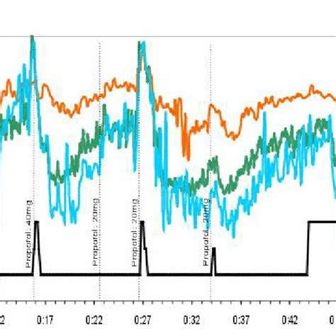 Measuring The Depth Of Anesthesia During Surgical Procedure Using Download Scientific Diagram