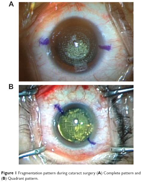 Evaluating The Different Laser Fragmentation Patterns Used In Laser Ca