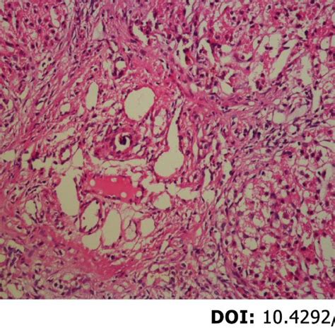 Liver Biopsy Of A Patient With Biliary Atresia A Cholestasis Arrow