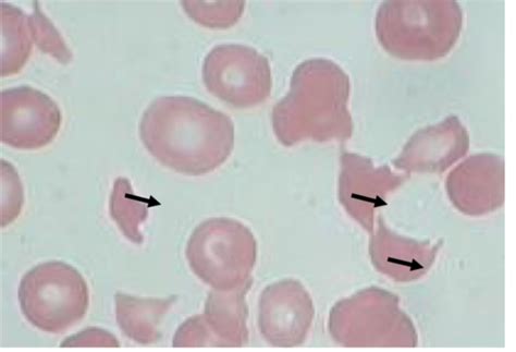 Normocytic Anemia Flashcards Quizlet