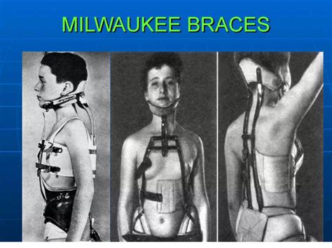 Prevention Malocllusion Pdf Dental Health Diseases And Conditions