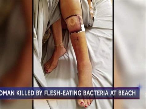 Flesh Eating Disease Face