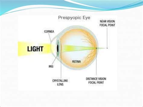 Anomalies Of Accommodation Ppt Eye And Vision Conditions Diseases