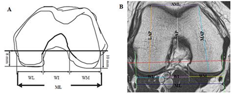 Schematic Representationa10 And Axial Mri Imageb Of The Distal Download Scientific