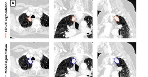 Deep Learning Model Helps Detect Lung Tumors Using Ct Scans 🔗 Bitly4jlqqe2 To The