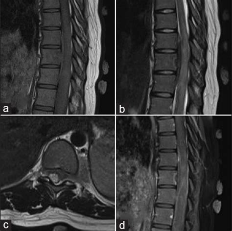 A Rare Case Of Dumbbell Shaped Primary Intraspinal Peripheral Primitive