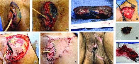 Radical Vulvectomy And Repair With Lymph Node Dissection A Anatomy