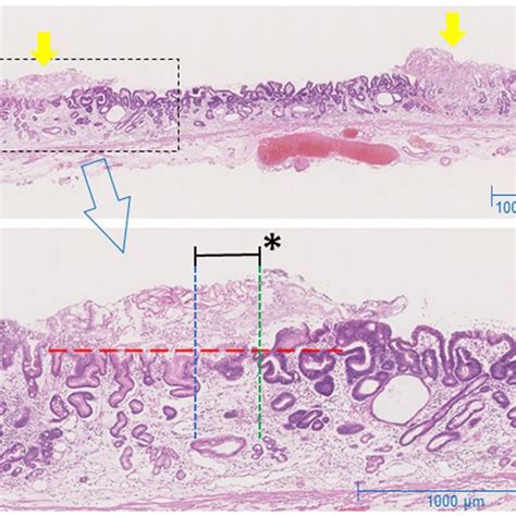 Three Dimensional Flexible Endoscopy Enables More Accurate Endoscopic Recognition And Endoscopic