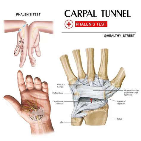 Healthy 🔈 Carpal Tunnel Syndrome And Phalens Test What Is Carpal