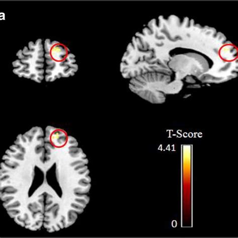 Group Differences In Functional Connectivity Within Dorsal Attention Download Scientific