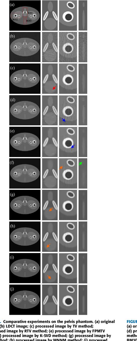 Figure 12 From Low Dose Ct Image Denoising Model Based On Sparse Representation By Stationarily