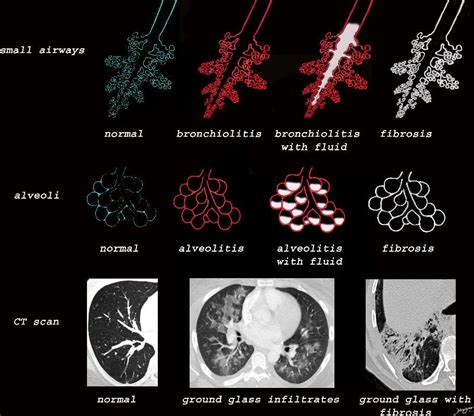 Art Of Ground Glass Lungs