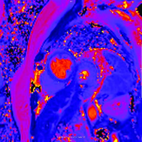 Cardiac Magnetic Resonance Parametric Mapping Showing Mildly Elevated