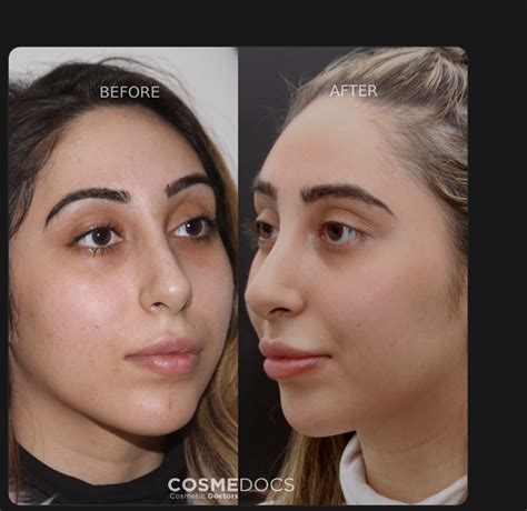 Masseter Botox Before And After Gallery Real Jawline Slimming Results