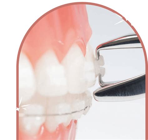 Laser Debonding Of Braces And Veneers Lightwalker