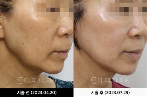잠실 울쎄라 전후사진 턱라인 이중턱 리프팅 효과 네이버 블로그