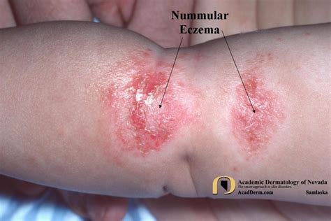 Nummular Eczema Academic Dermatology Of Nevada