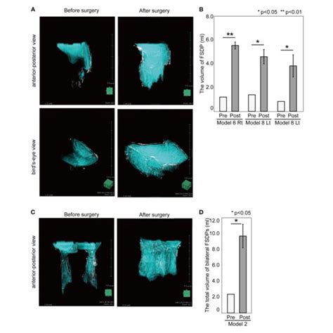 The Volume Of Fsdp Before And After The Frontal Sinusotomies And The Download Scientific