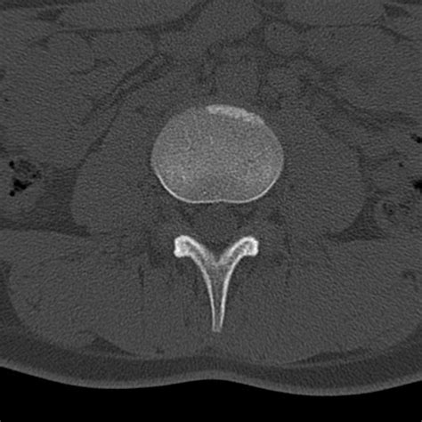 Bilateral Pars Defect Radiopaedia 26691 26846 Axial Bone Window Nc Commons