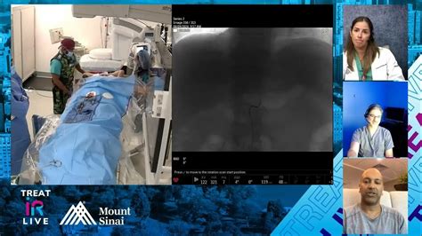 Y90 Radioembolization With Glass Microspheres For Infiltrative