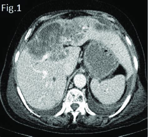 A 56 Year Old Female Patient Diagnosed With Alveolar Echinococcosis