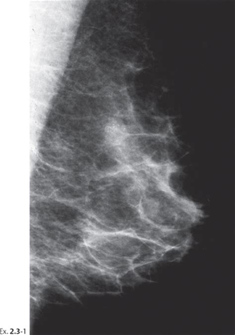 Group 1 One Or Two Clusters Of Crushed Stone Like Calcifications Of The Mammogram Produced By