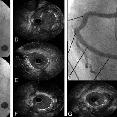 A RCA Subtotal Occlusion Recanalized By Pilot 50 Hydrophilic Wire And Download Scientific