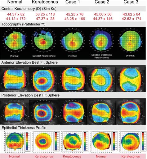 Keratoconus Posterior Elevation
