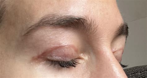 Blepharoplasty 5 Weeks Ago R Plasticsurgery