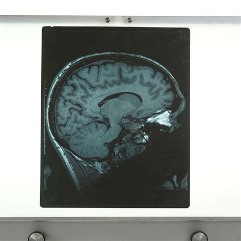 X Ray Brain Film Medical
