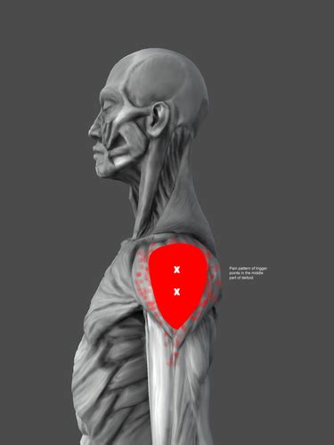 Trigger Point Referrals Flashcards Quizlet