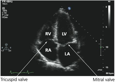 Figure 7 15 A Normal Echocardiogram Project Tulip Academy