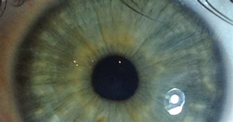 Modern And Multidimensional Iridology Radial Furrows At Pupillary Zone