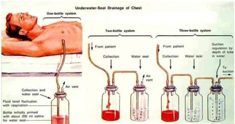 Chest Tube Insertionclosed Thoracostomy 호흡기 공부방 바오로천사